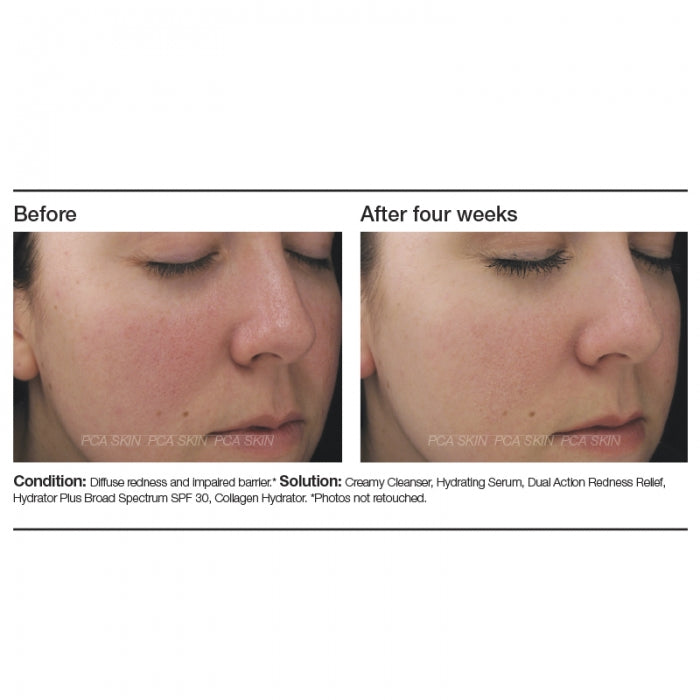 PCA Skin Dual Action Redness Relief - | EMstore.com – DermaPro.com